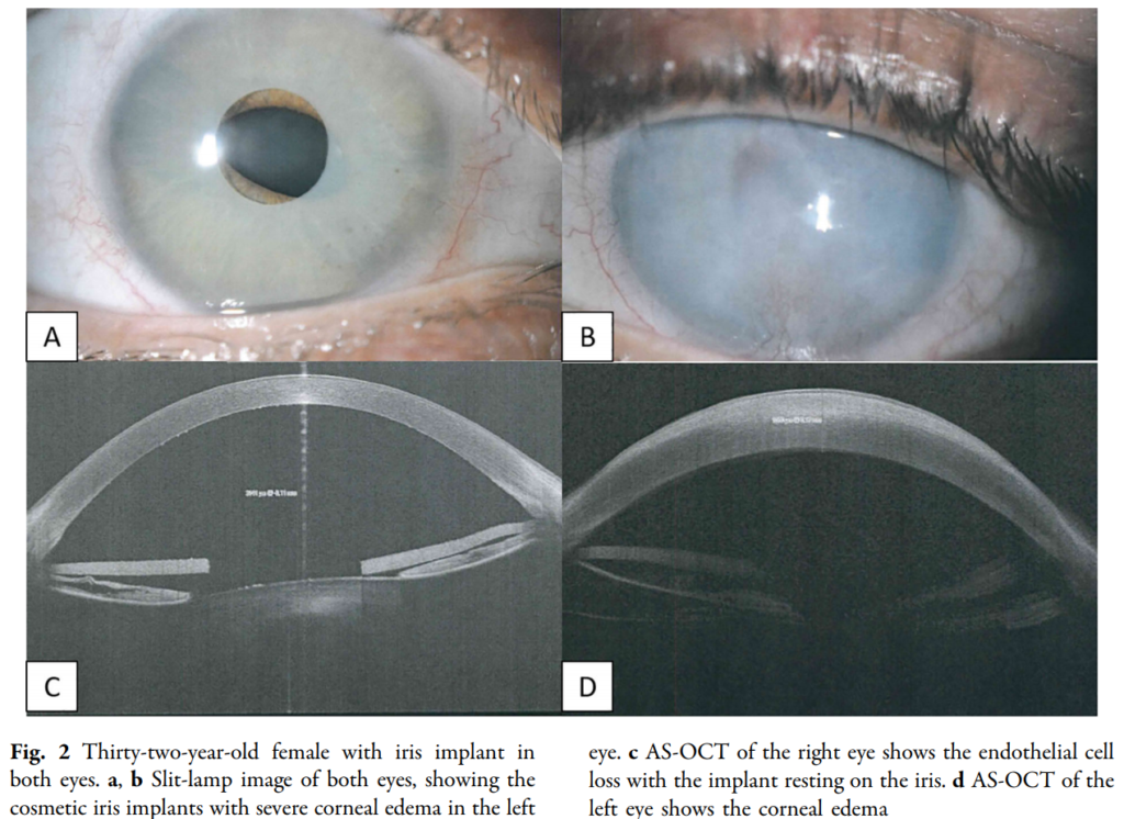 Cosmetic Change of the Apparent Color of the Eye: A Review on Surgical ...
