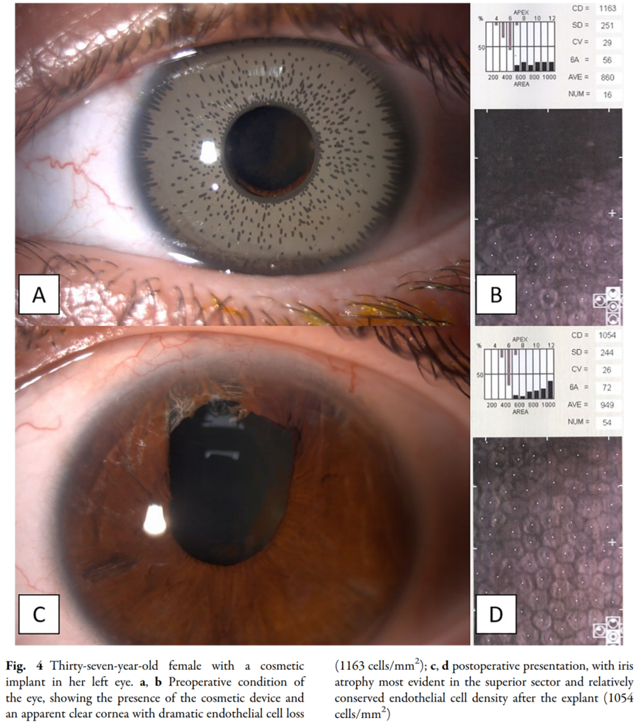 Cosmetic Change of the Apparent Color of the Eye: A Review on Surgical ...
