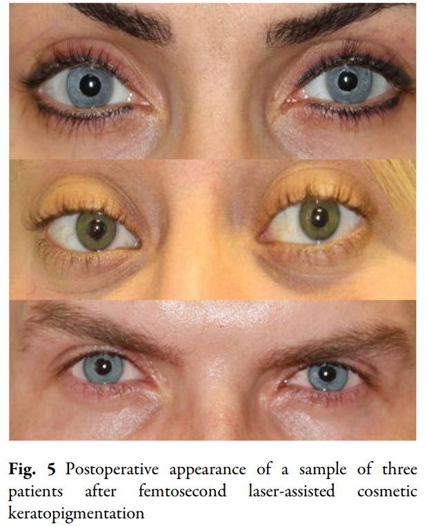 Cosmetic Change of the Apparent Color of the Eye: A Review on Surgical ...